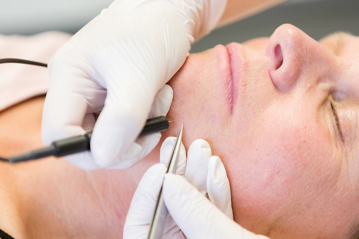 Elektrische epilatie - Triaderm - Welkom bij dé huidspecialist van regio Utrecht en Arnhem