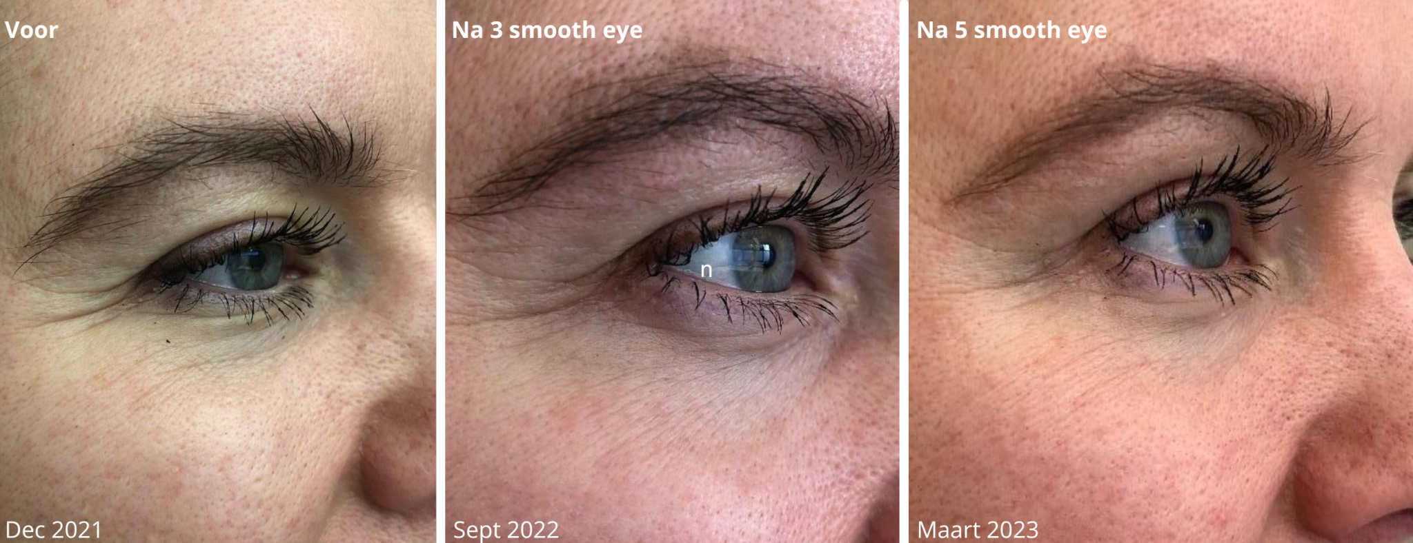 De Fotona SmoothEye laserbehandeling - Triaderm - Welkom bij dé ...